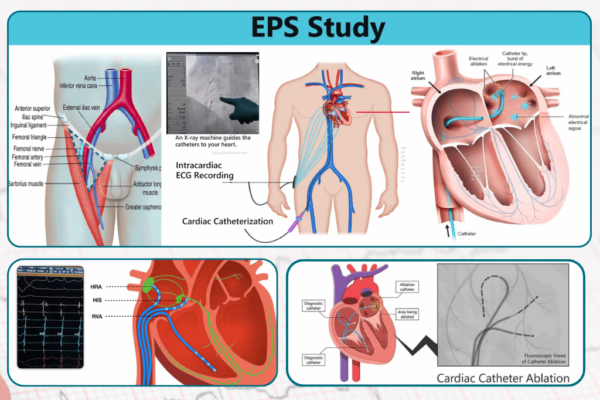 Best EP Study and RFA Treatment in Guwahati | 24x7 Cardiac Care
